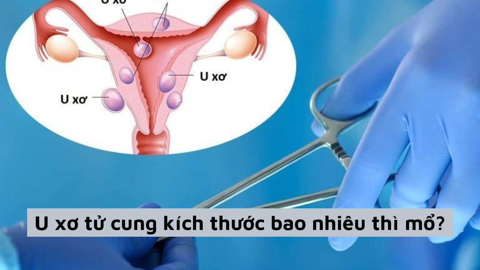 Giải đáp thắc mắc: U xơ tử cung kích thước bao nhiêu thì mổ được?