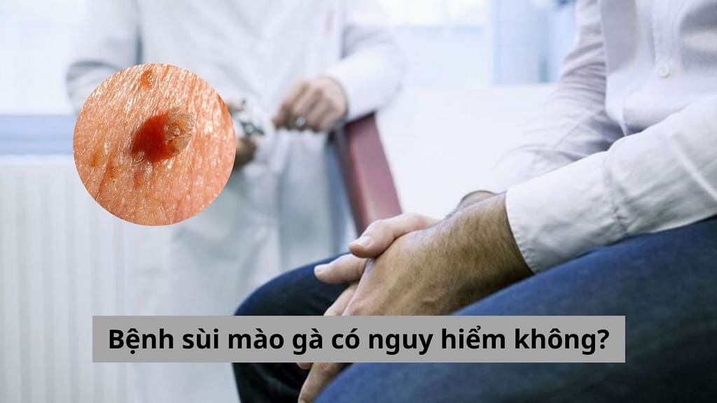 [Góc giải đáp] Bệnh sùi mào gà có nguy hiểm không?