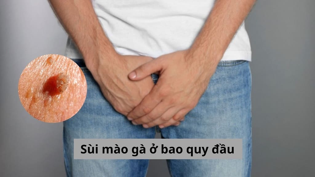 Sùi mào gà ở bao quy đầu - Nam giới cần nắm rõ những gì?