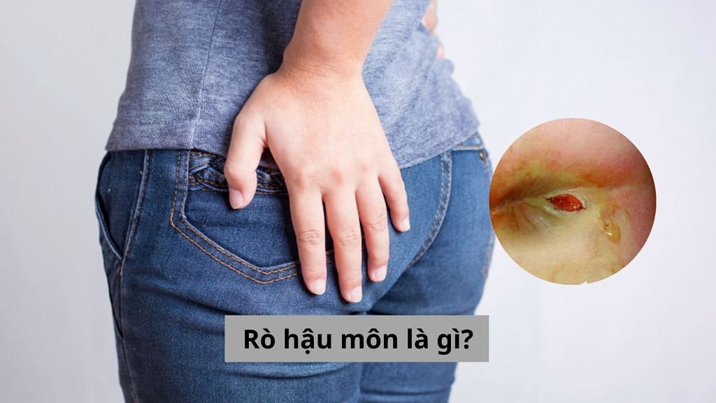 Rò hậu môn là gì: Tìm hiểu về khái niệm, triệu chứng và cách điều trị