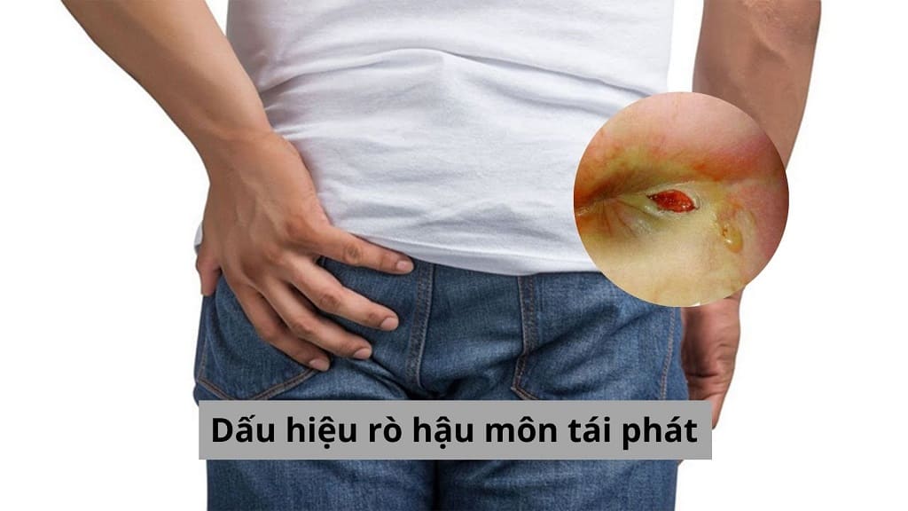 Dấu hiệu rò hậu môn tái phát: Bạn cần biết những điều này