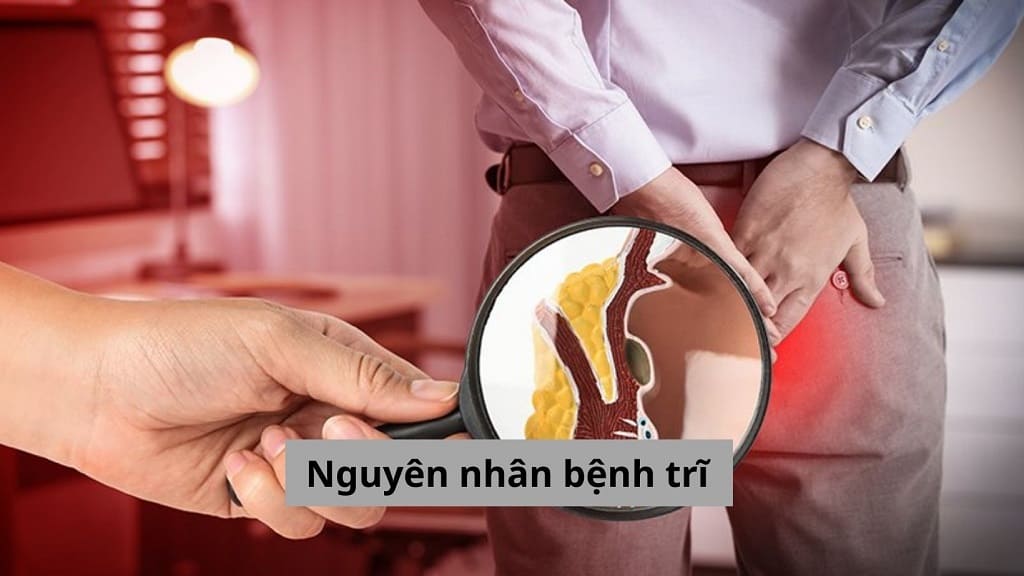 Giải đáp thắc mắc: Nguyên nhân bệnh trĩ đến từ đâu?