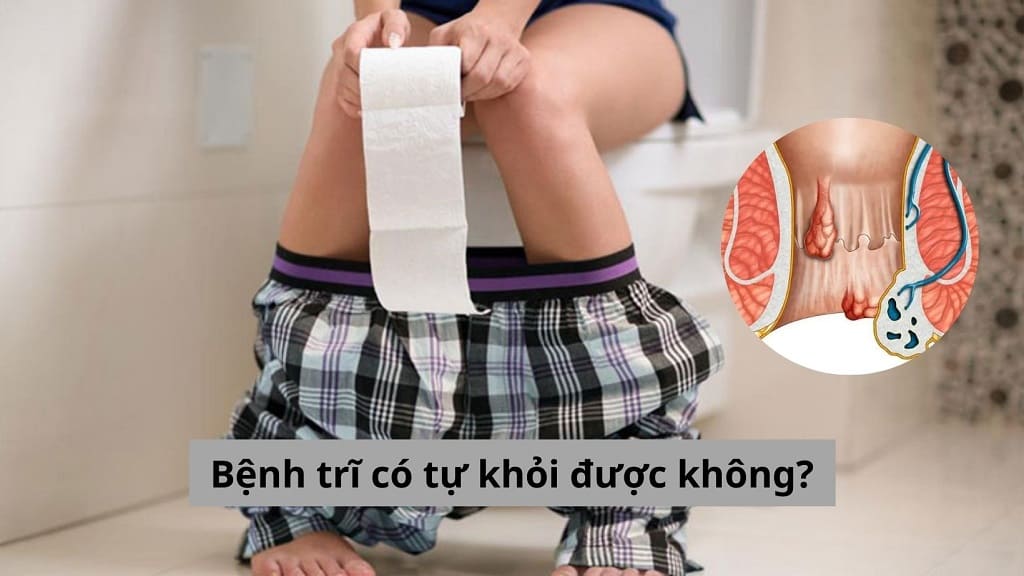 [Giải đáp] Thực hư vấn đề bệnh trĩ có tự khỏi được không?